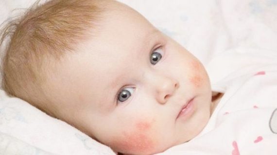 Bebeklerde İsilik Tedavisi, Bebeklerde İsilik Nasıl Olur, Nasıl Geçer?